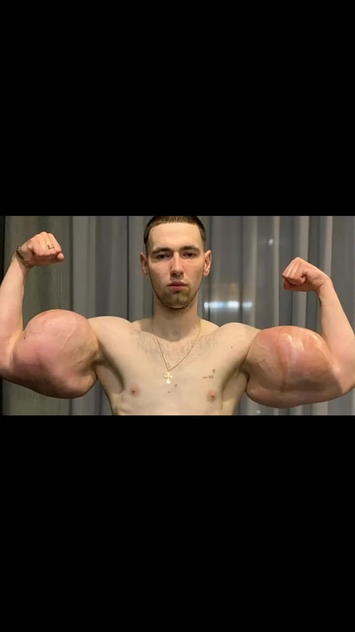 The Famous Russian Synthol Dudes Bicep Finally Exploded